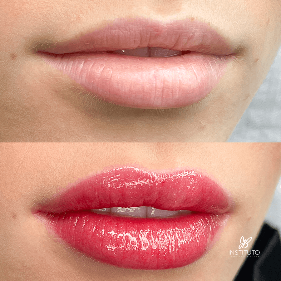 Revitalização Labial